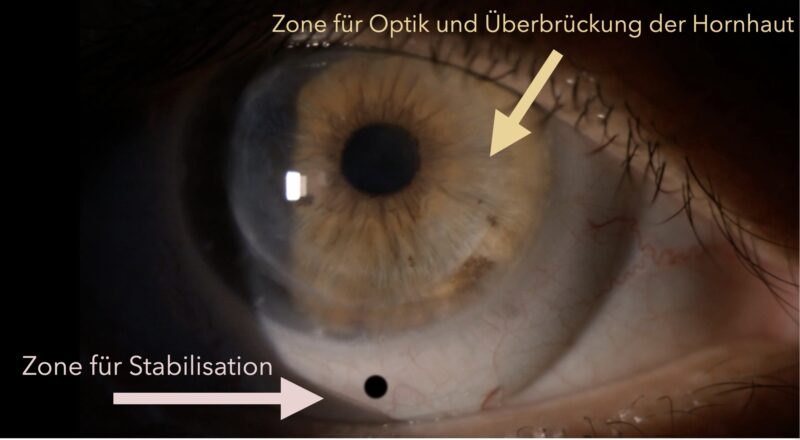 Kontaktlinsen mit prismatischer Korrektur – Was wirklich möglich ist ...